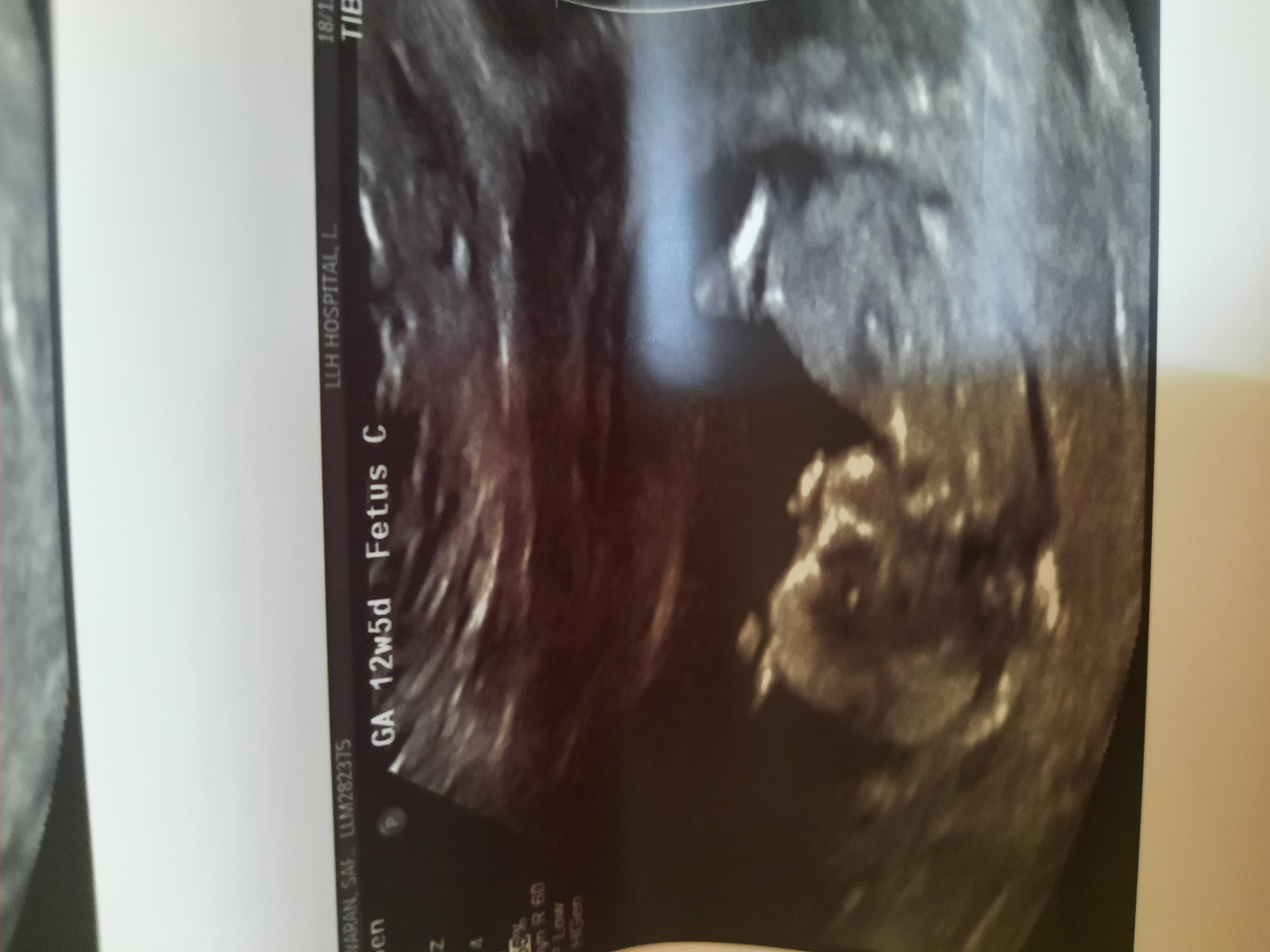 13 Week Scan Girl or Boy???