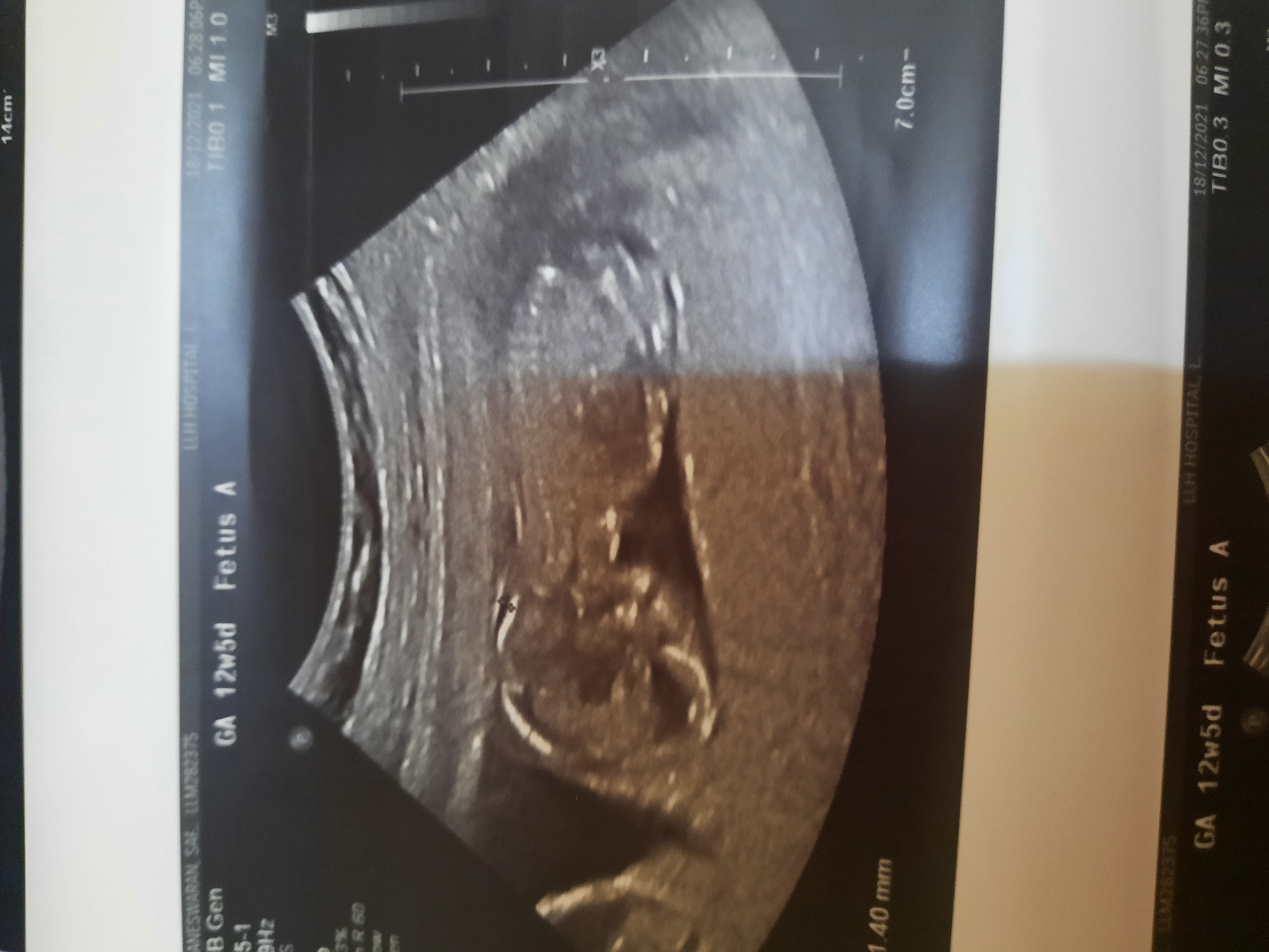 13 Week Scan Girl or Boy???