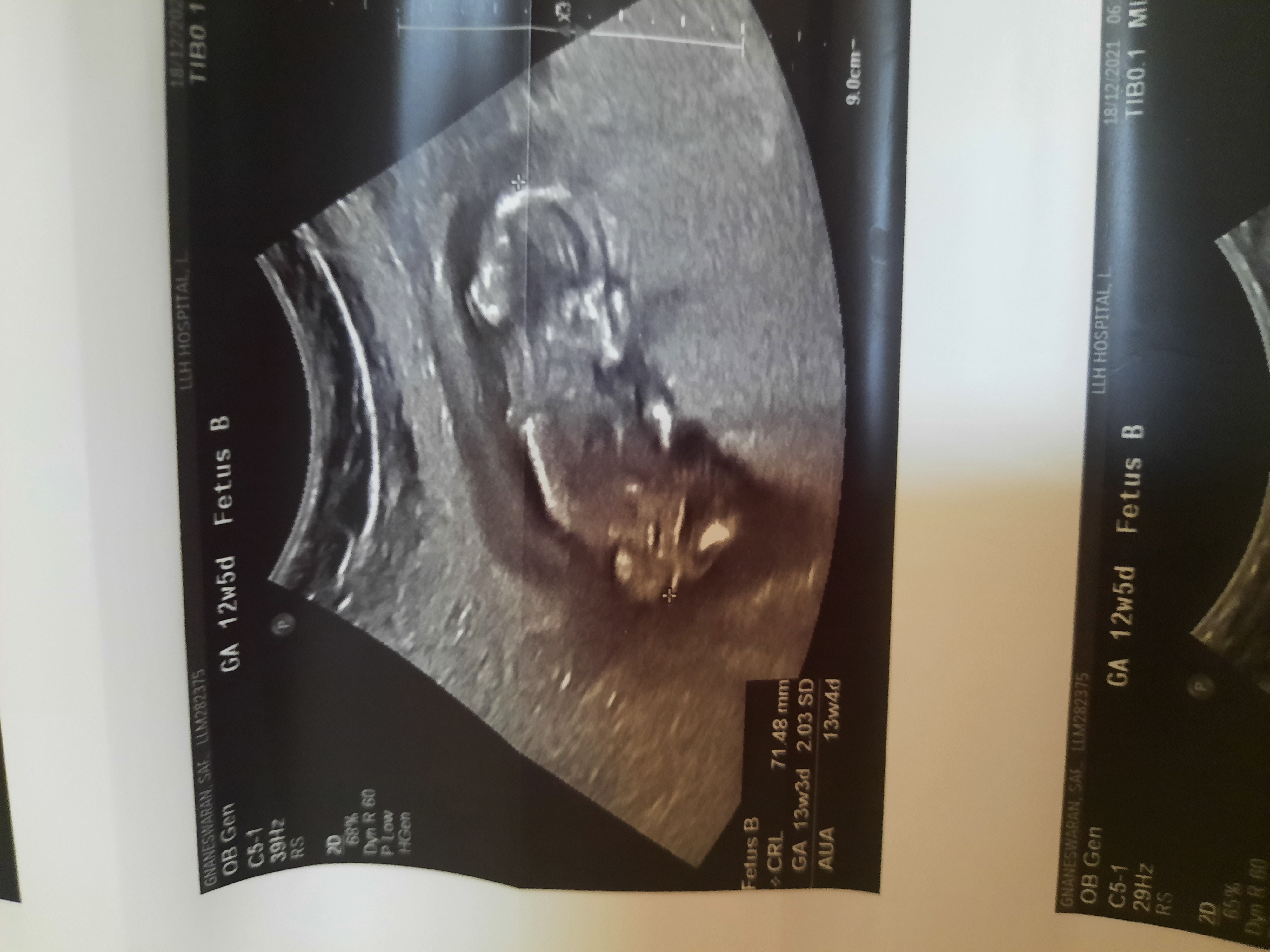 13 Week Scan Girl or Boy???